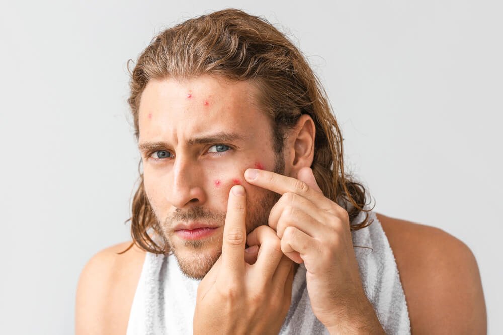 Acneea vulgara(adulta): factori declansatori si de agravare a acesteia