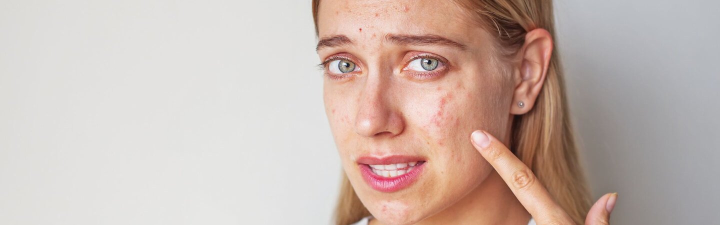 Tratamente acnee: cauze, soluții, produse | La Roche-Posay