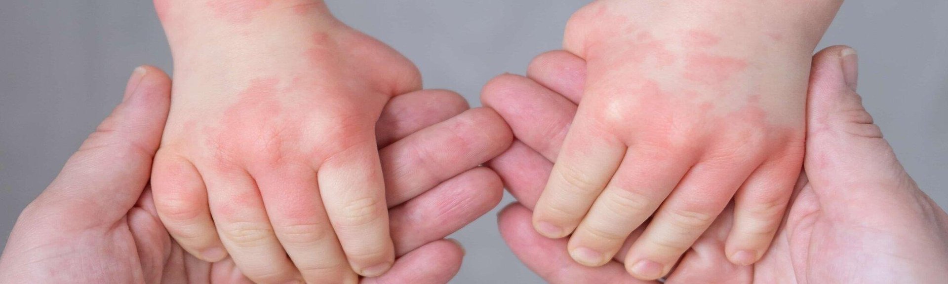 Dermatita de contact, poze si simptome | La Roche-Posay