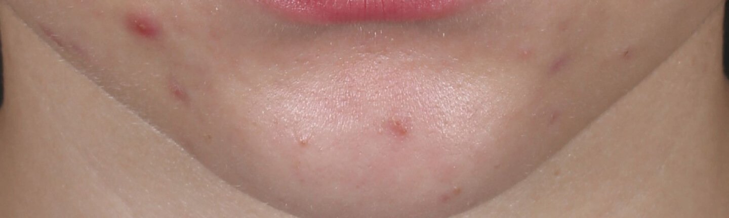 Papule si Pustule – Ghid de Ingrijire cu La Roche-Posay