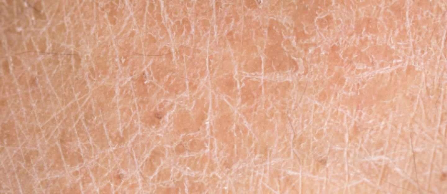 Ce boli ascunde pielea uscata: Xeroza cutanata, Maini crapate poze