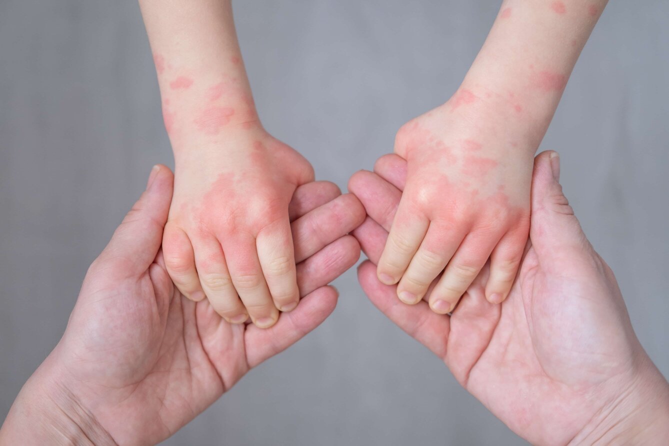 Dermatita atopica si eczema piele atopica: tot ce trebuie sa stii